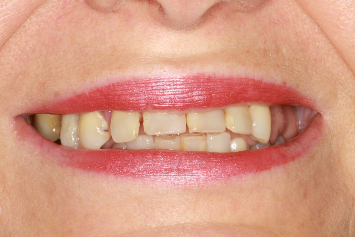 Ar tikrai visus dantis galima atkurti per vieną dieną? - Skandinavijos ...